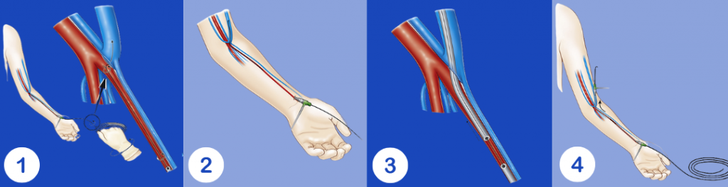 Hemodialysis - Monterey Bay Vascular
