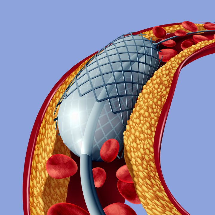 Arterial Disease Treatment - Monterey Bay Vascular