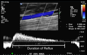 Chronic Venous Insufficiency (CVI) - Monterey Bay - Aptos & Salinas CA